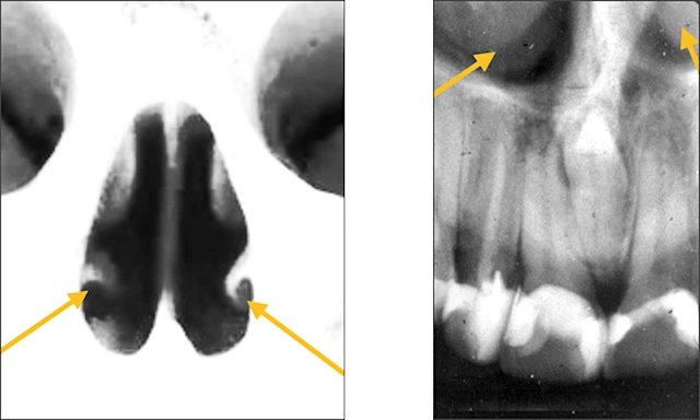 Maxillary Anterior Landmarks - Intraoral Radiographic Anatomy - Dentalcare