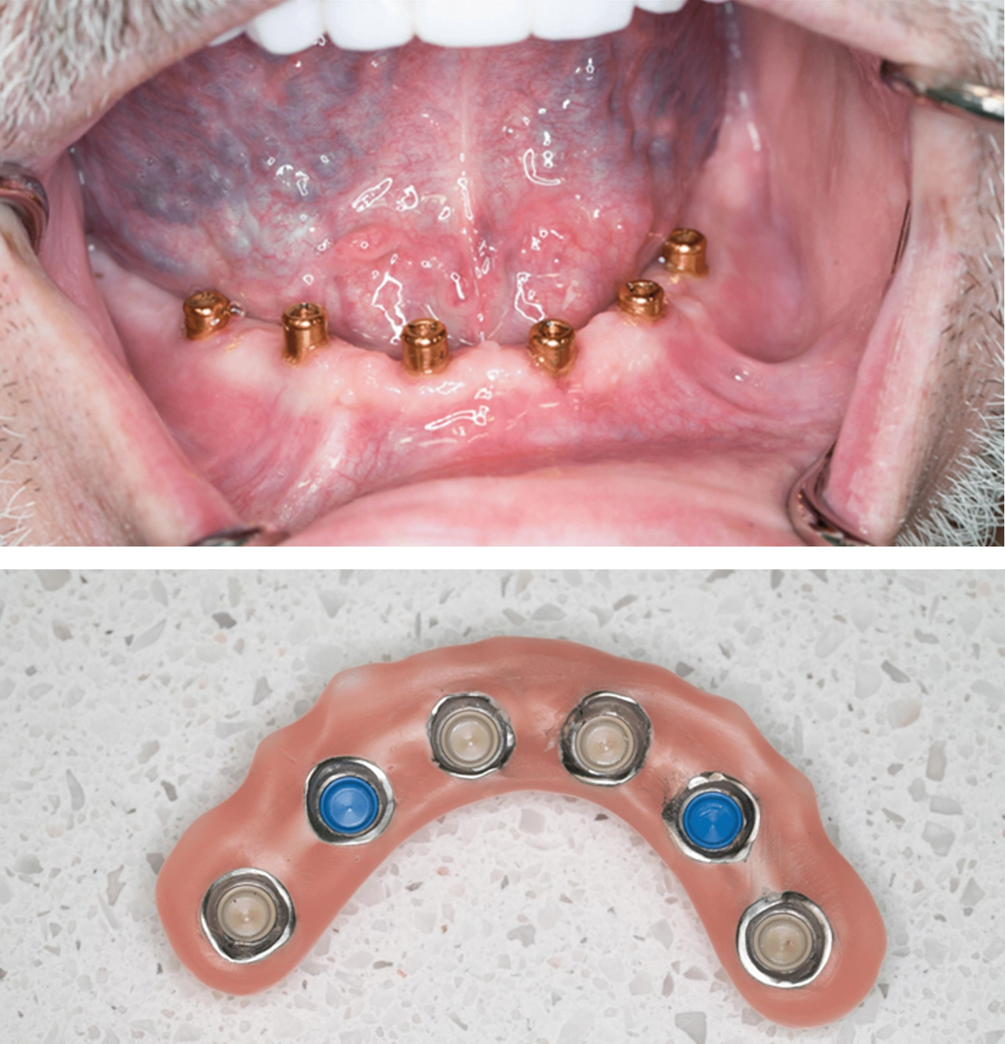 Mode of Retention of Fixed Implant Prosthesis - Full Arch Implant ...