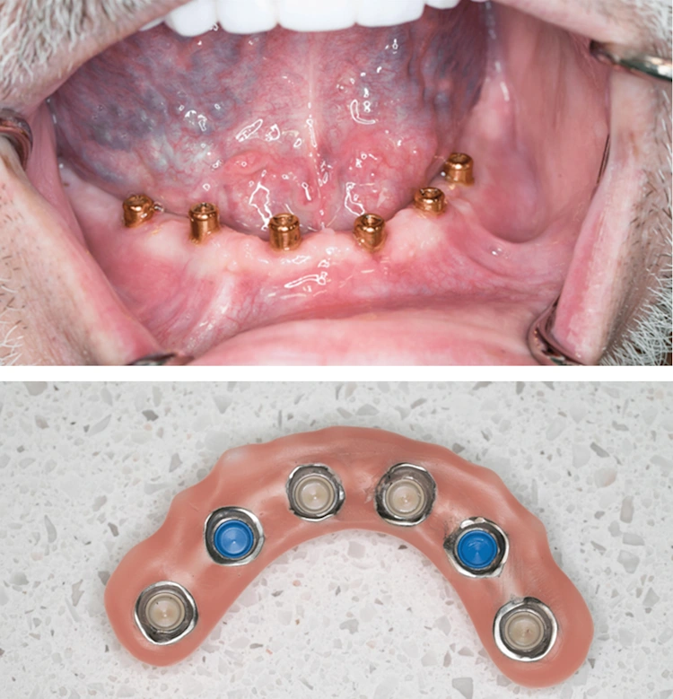 Mode of Retention of Fixed Implant Prosthesis - Full Arch Implant ...