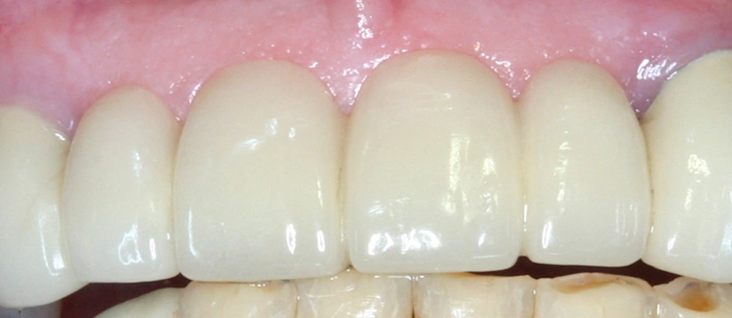 Assessment of the Form of Adjacent Teeth | Biologically Contoured ...