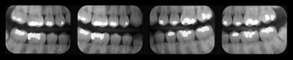 Intraoral Radiographic Techniques - Intraoral Imaging: Basic Principles ...