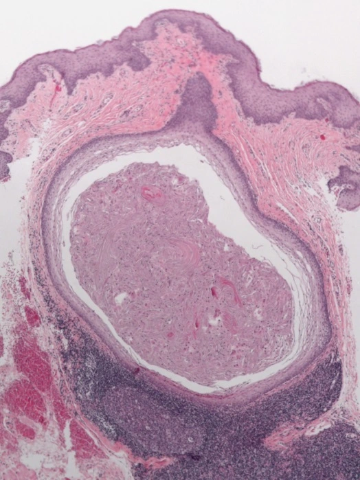 Diagnostic Information | Papule in the Right Floor of the Mouth ...