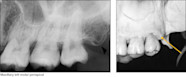 Maxillary Tuberosity Radiograph