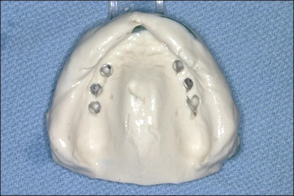 First Clinical Appointment - Full Arch Implant Prostheses: Part II ...