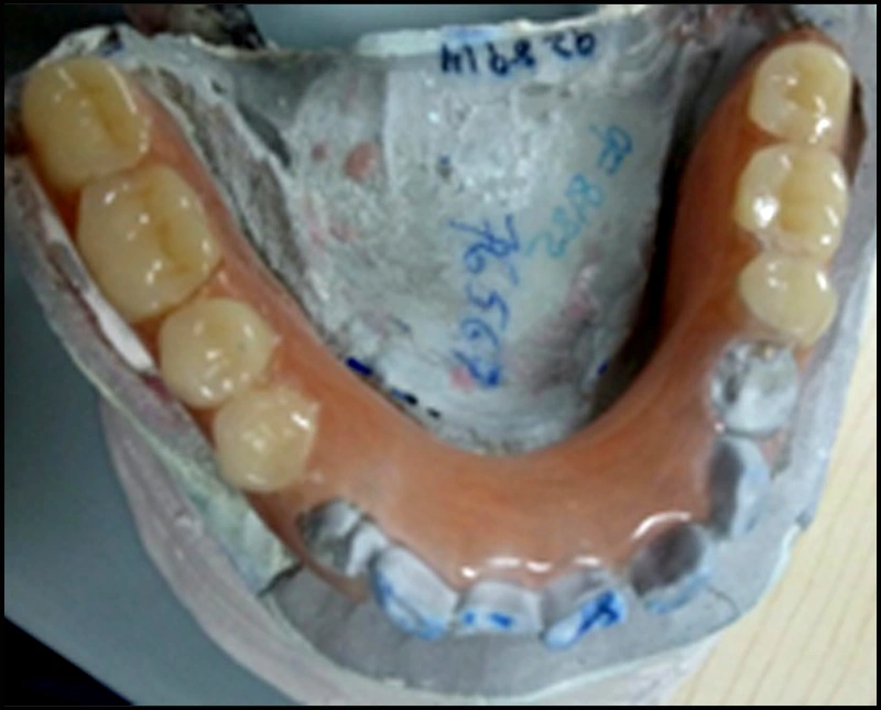 Prosthesis Design | Non-Metal Clasp Dentures | Continuing Education ...