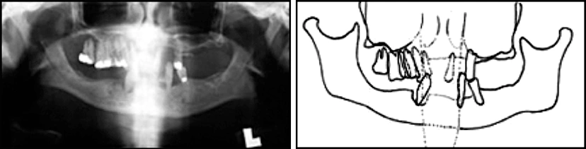 Tissue Projection Errors - Practical Panoramic Imaging - Dentalcare