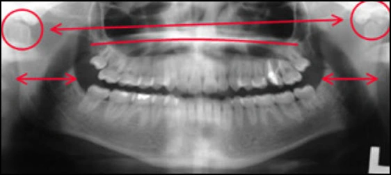 Features of an Optimal Panoramic Radiograph - Practical Panoramic ...