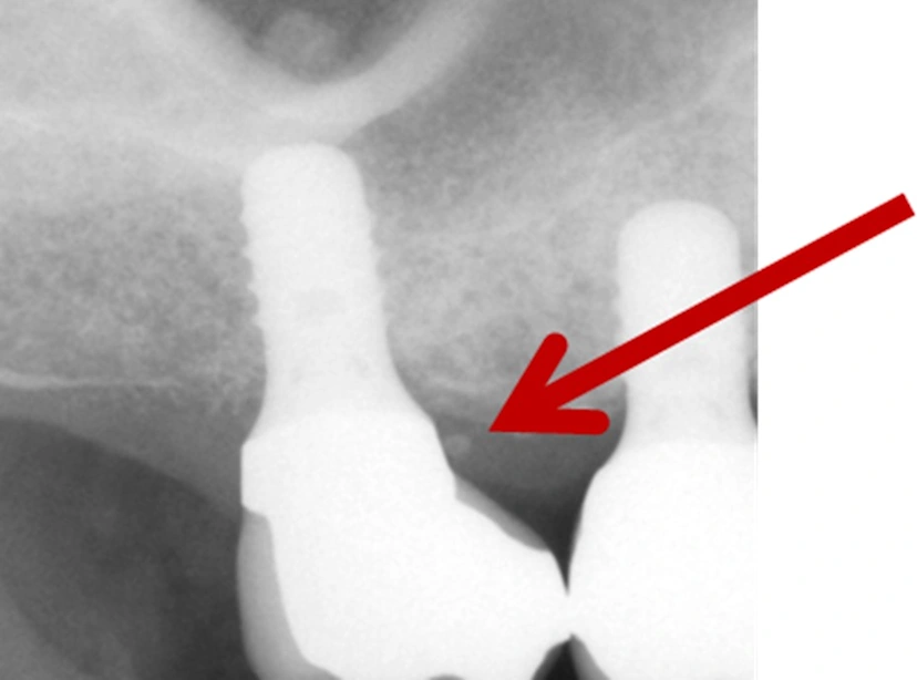 Implant Related Risk Factors | Peri-implantitis: All You Want (or not ...