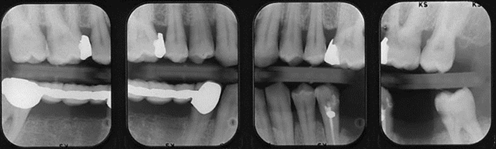 Radiographic Examination of the Patient with Active Periodontal Disease ...