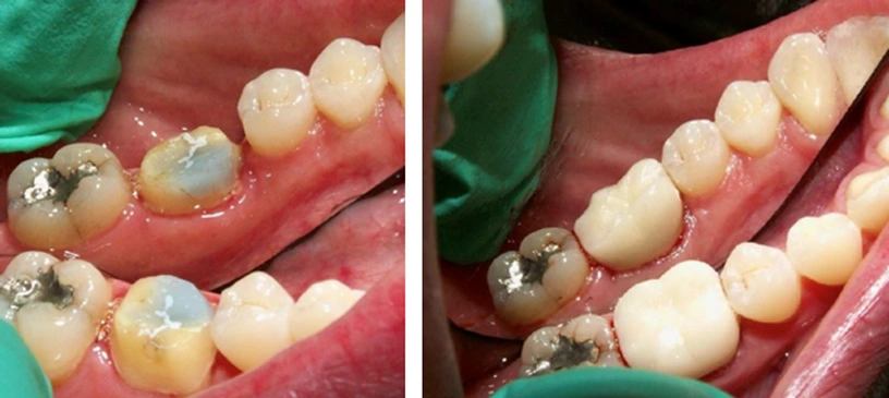 Crown Lengthening with Minimally Invasive Flap Design | Lasers in ...