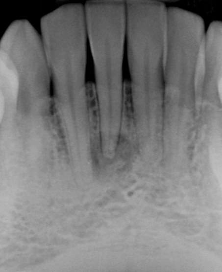 Diagnostic Information | Periapical Lesion Involving a Mandibular ...