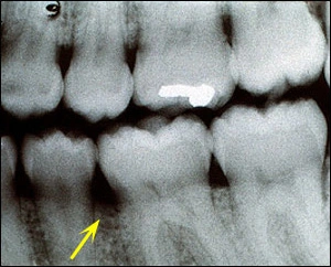Diagnostic Information | The Case of the Hemorrhagic Gingival Mass ...