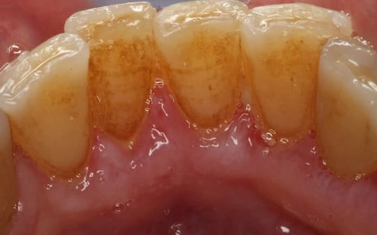 Chromogens On and In Teeth – Definitions and Origins | How Whitening ...