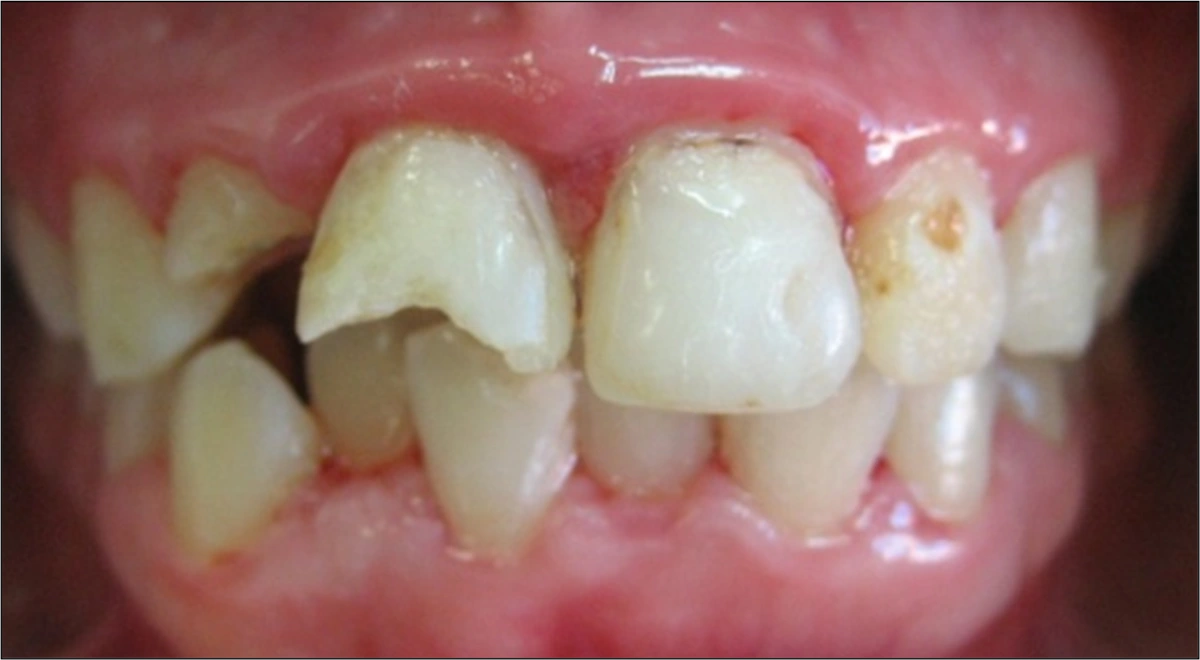 Oral and Dental Injuries | Sports dentistry - Education and Prevention ...