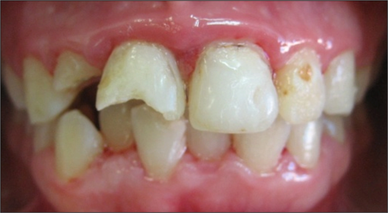 Oral and Dental Injuries | Sports dentistry - Education and Prevention ...