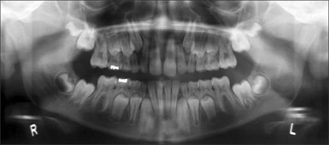 Primary and Permanent Dentition Eruption Sequences - Anomalies of Tooth ...