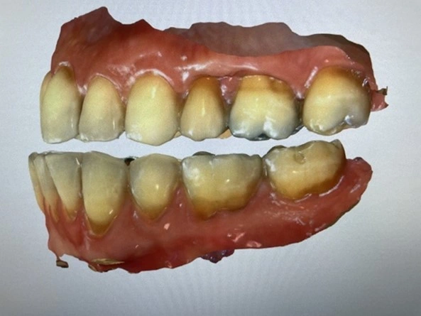 Dental Impressions/Scanning and Bite Registration - Sleep Apnea ...