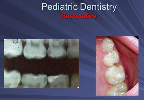 Lasers in Pediatric Dentistry | Lasers in Dentistry: Minimally Invasive ...