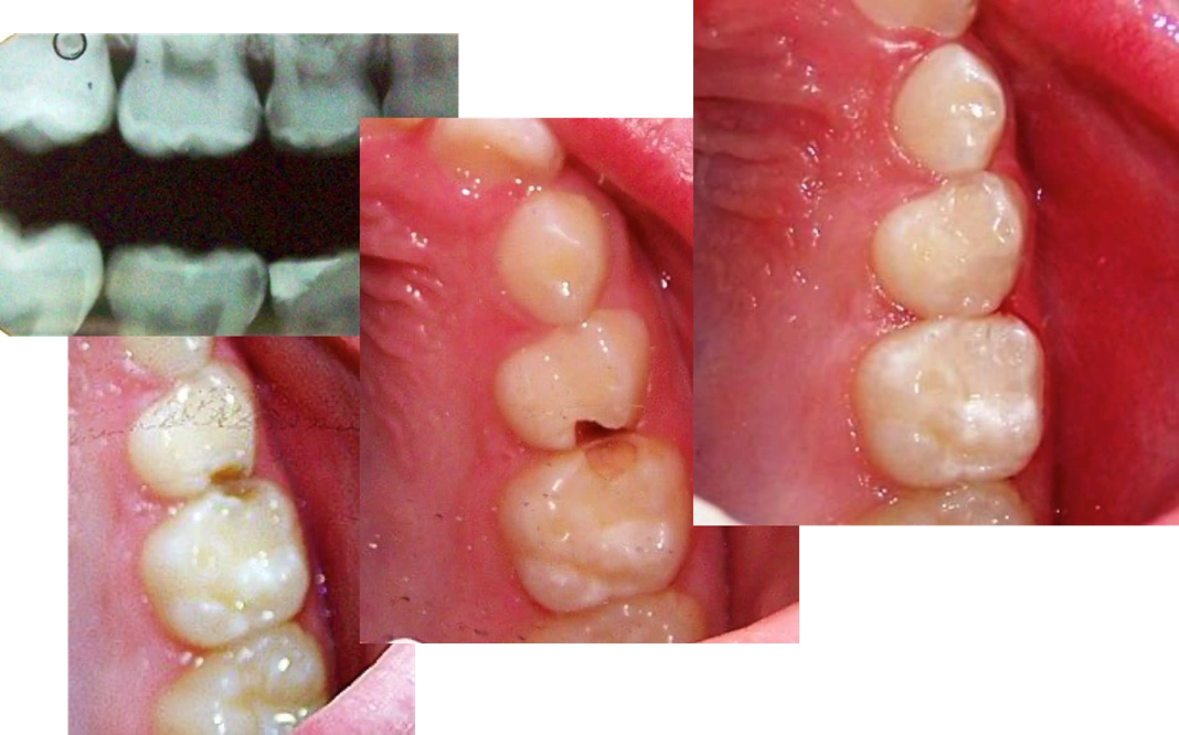 Lasers in Pediatric Dentistry | Lasers in Dentistry: Minimally Invasive ...