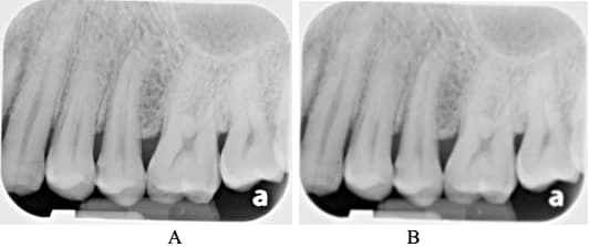 Image Sharpness - The Radiographic Image - Dentalcare