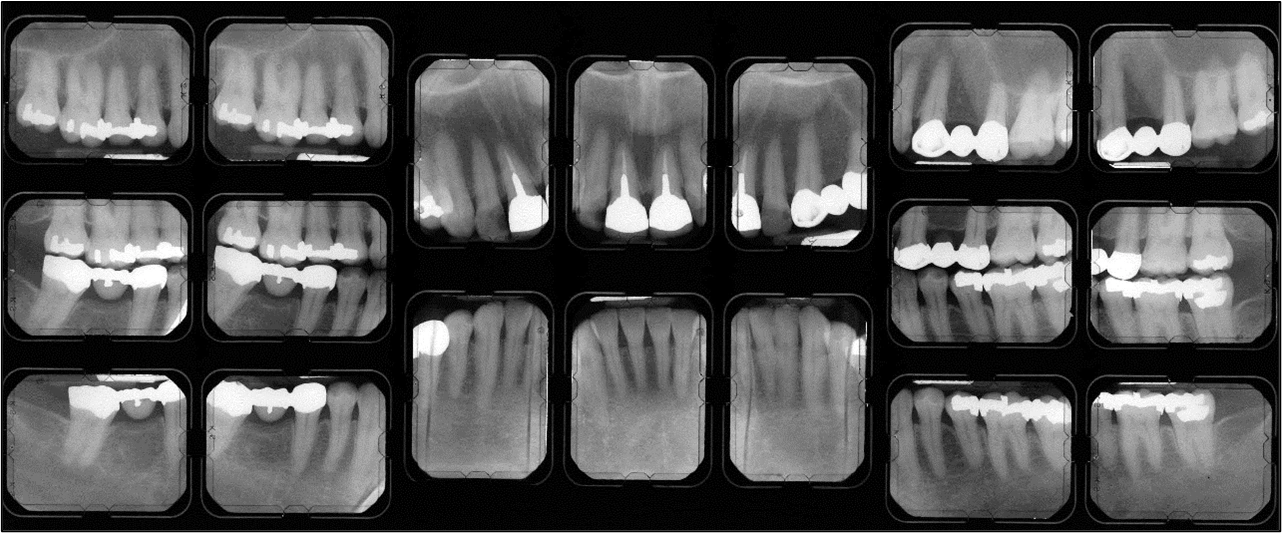 Adult Dentate Patient - Radiographic Selection Criteria - Dentalcare