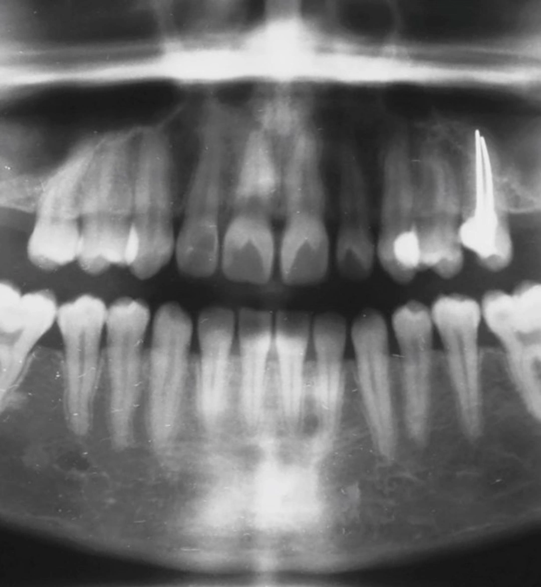 Accessory Cusps - Anomalies of Tooth Structure - Dentalcare