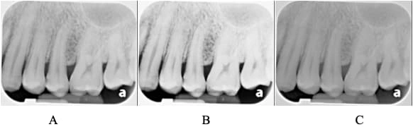 Radiographic Density - The Radiographic Image - Dentalcare