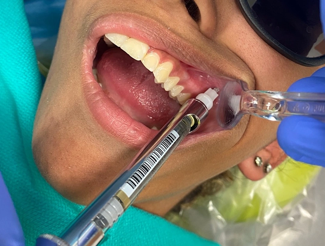 Posterior Superior Alveolar Nerve Block - Local Anesthesia in Pediatric ...