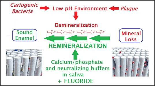 Fluoride and Caries Prevention - An Update on Demineralization ...