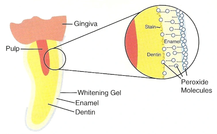 Decolorization of Stains: Mechanisms of Oxidative Tooth Whitening | How ...