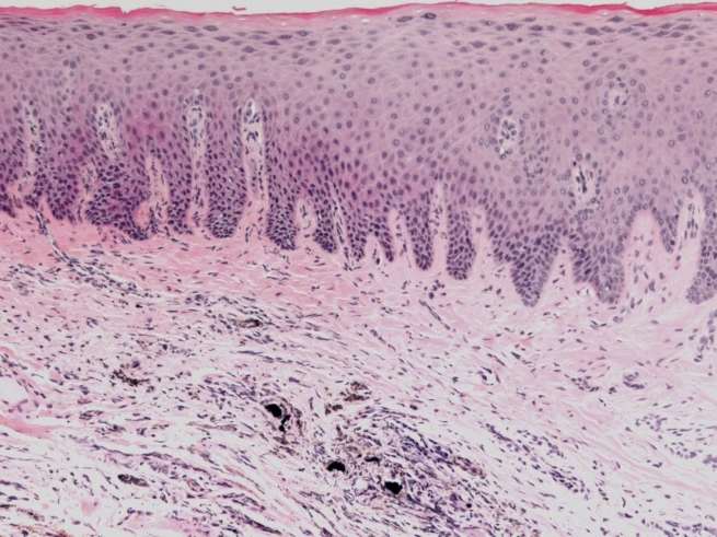 Diagnostic Information | Incidental Blue-Gray Macule on Palate ...