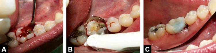 Crown Lengthening with Minimally Invasive Flap Design | Lasers in ...