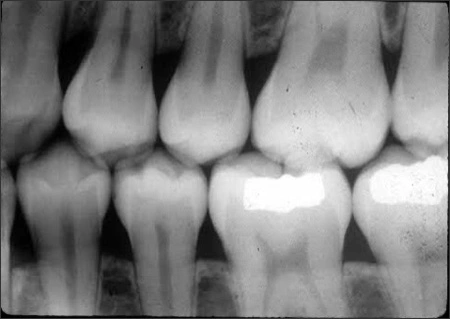 Normal Radiographic Appearance of Teeth - Anomalies of Tooth Structure ...
