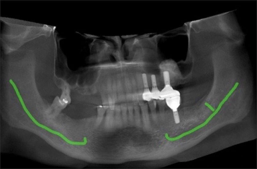 Anatomical Overview - Alveolar Ridge Preservation and Augmentation for ...