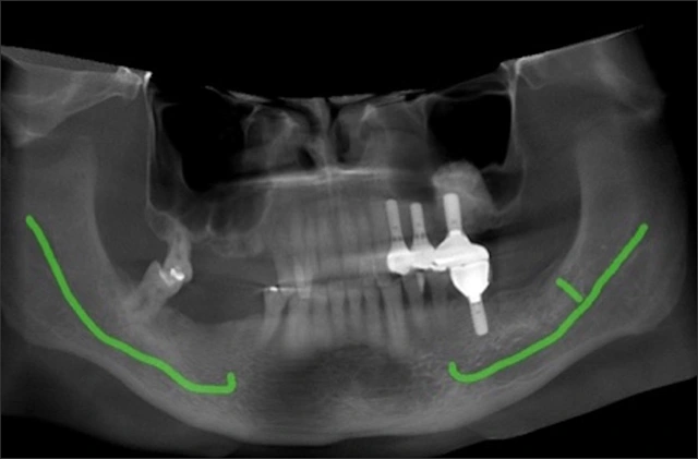 Anatomical Overview - Alveolar Ridge Preservation and Augmentation for ...