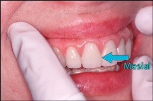 Terms M-Z - Oral Health Care: A Whole New Language - Dentalcare