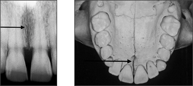 Maxillary Anterior Landmarks - Intraoral Radiographic Anatomy - Dentalcare