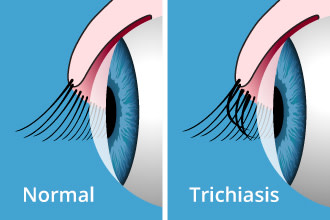 Trichiasis Treatment