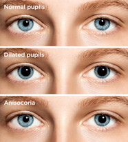 Normal Pupil Size Chart Oasisqust