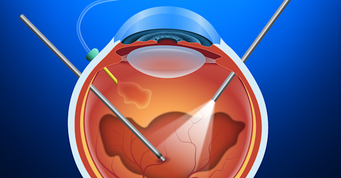 Vitrectomy and Vitreoretinal Procedures - AllAboutVision.com