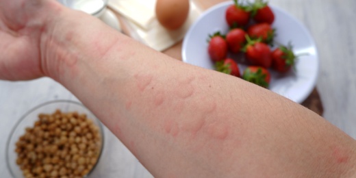 Food Allergens: Risks and Safety Measures | SafetyCulture