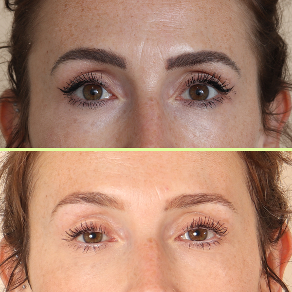 Our unique LightSense® laser system is gentle enough to treat the skin ...