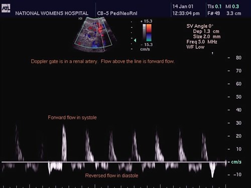 Patent Ductus Arteriosus (PDA) in the newborn