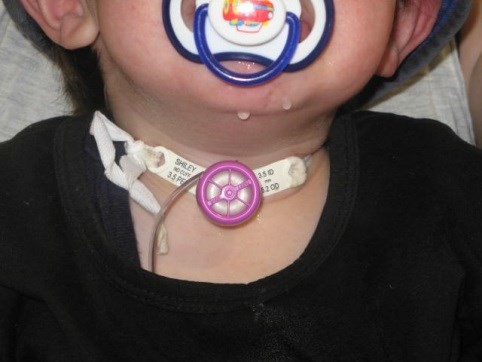 Tracheostomy management for an infant, child or young person