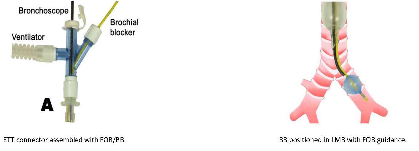Single lung ventilation at Starship