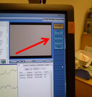 Brain monitoring in the neonate - Video aEEG