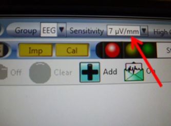 Brain monitoring in the neonate - Video aEEG