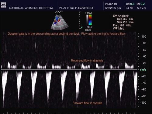 Patent Ductus Arteriosus (PDA) in the newborn