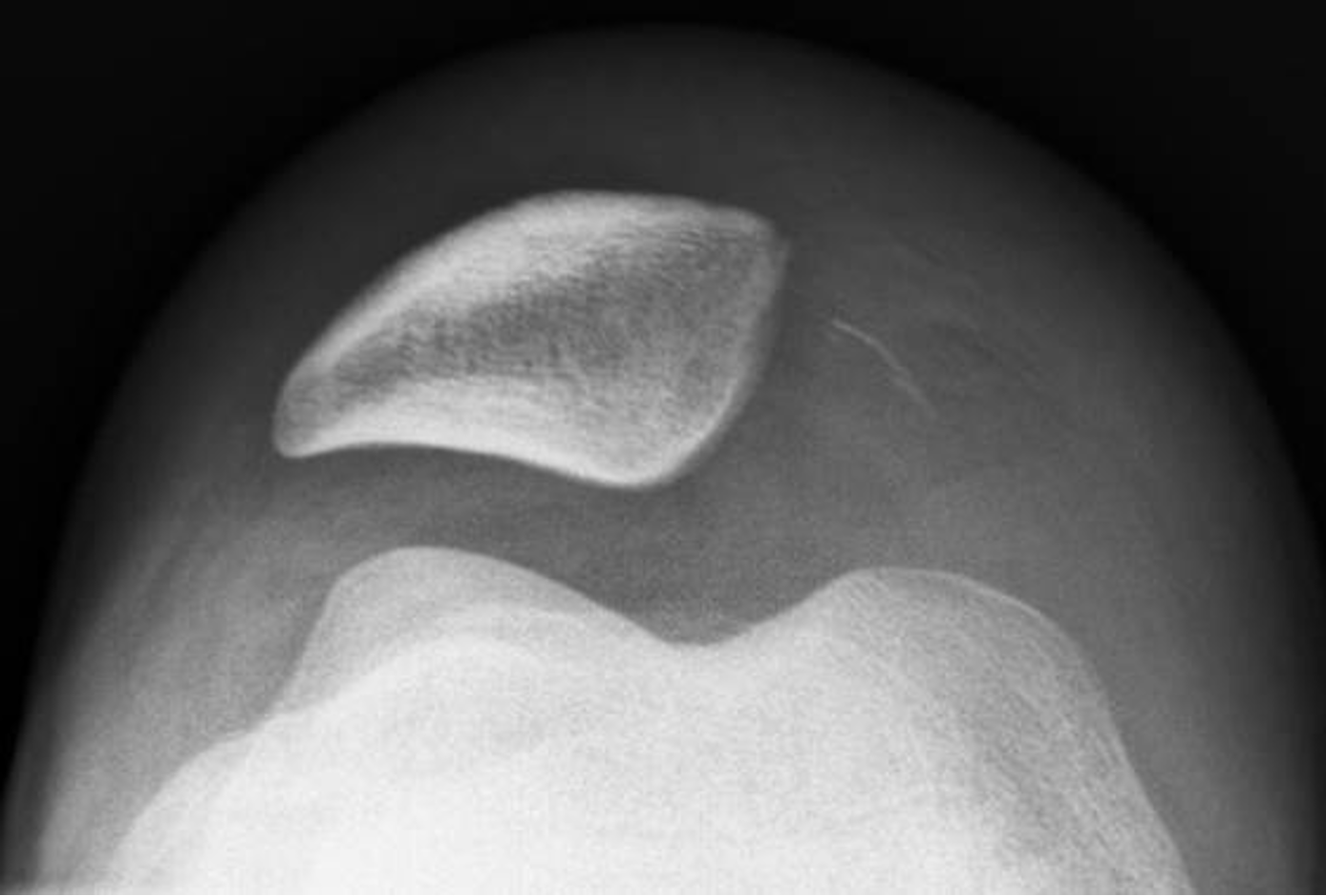 Avulsion of the medial patella border