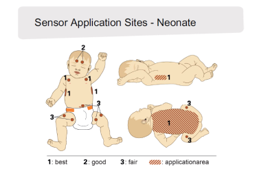 Transcutaneous CO2 monitoring